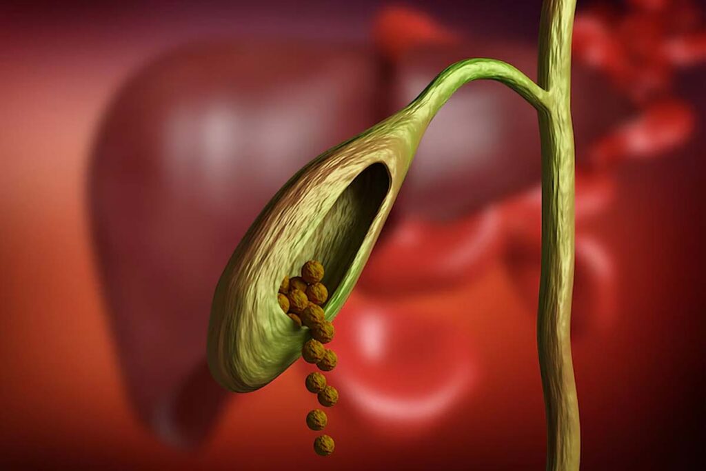 Gallstone Reversal Program – Functional Medicine